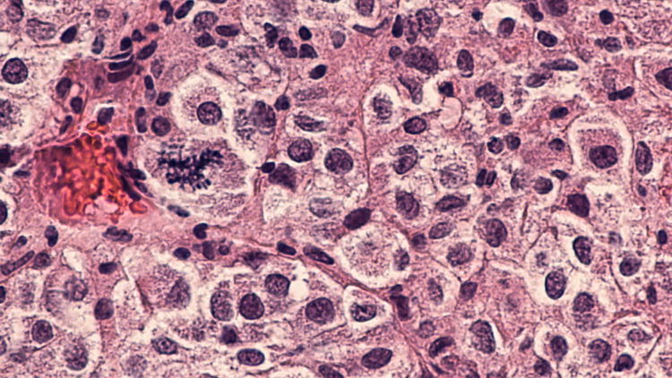 Best Melanoma Treatment Doctors in LA | BHSkin Dermatology