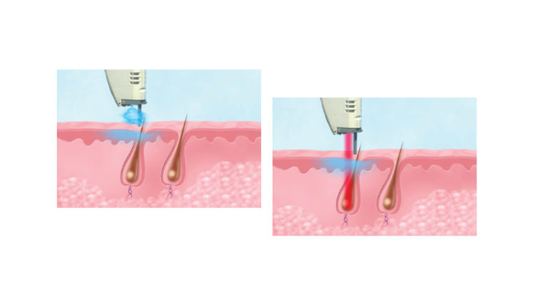 VBeam Laser Nearby In Los Angeles [Learn The Side Effects]