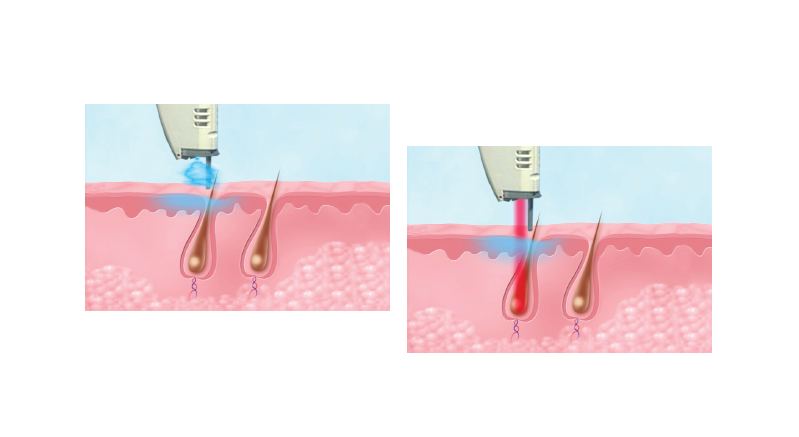 VBeam Laser Treatment in Los Angeles | BHSkin Dermatology