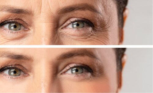 Botox Recovery & Aftercare (Healing & Results Timeline)