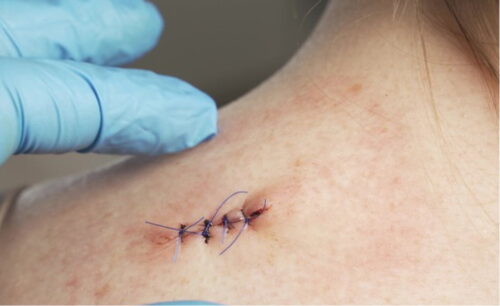 Mohs Surgery Recovery & Aftercare Guide [What You Need To Know]