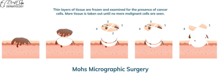 Mohs Surgery Recovery & Aftercare Guide [What You Need To Know]
