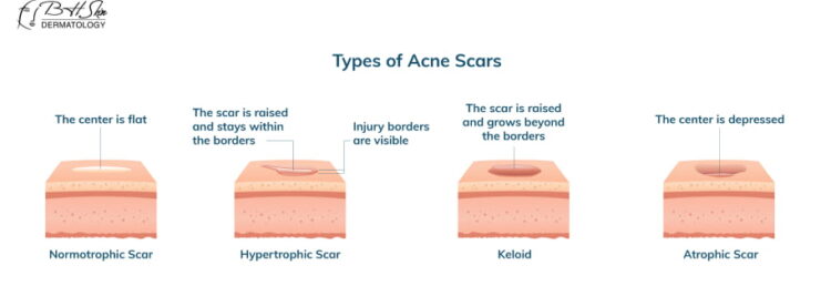 Best Acne Scar Removal Treatments & Products (Complete Guide)