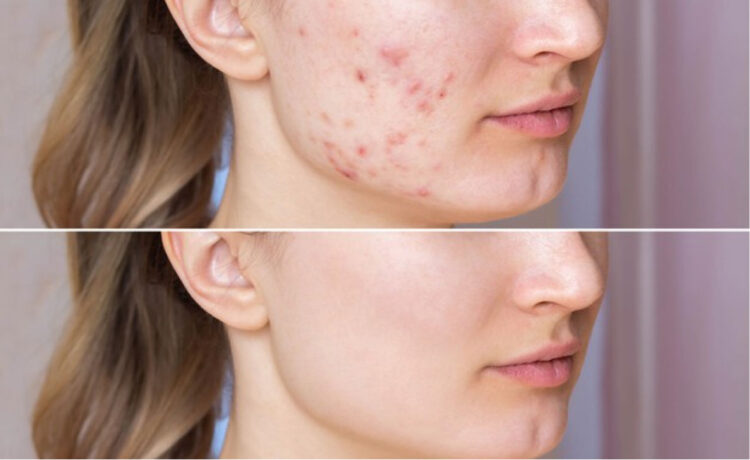 Microneedling Recovery & Aftercare Guide [Get The Best Results]