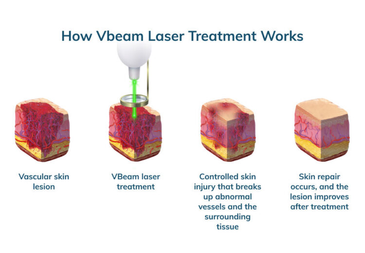 Vbeam Laser Recovery Guide [Do's & Don'ts To Maximize Recovery]