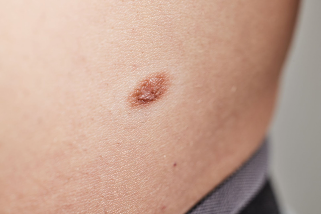 Can I Visit a Cosmetic Dermatologist for Weird Moles? - BHSkin Dermatology