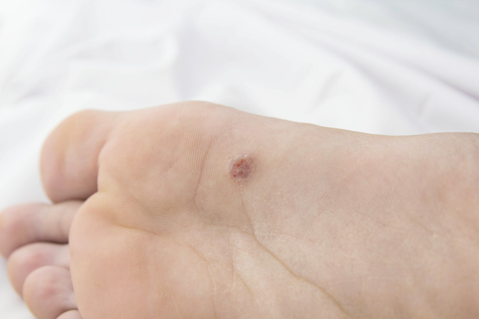What causes plantar warts? | Causes and Solutions