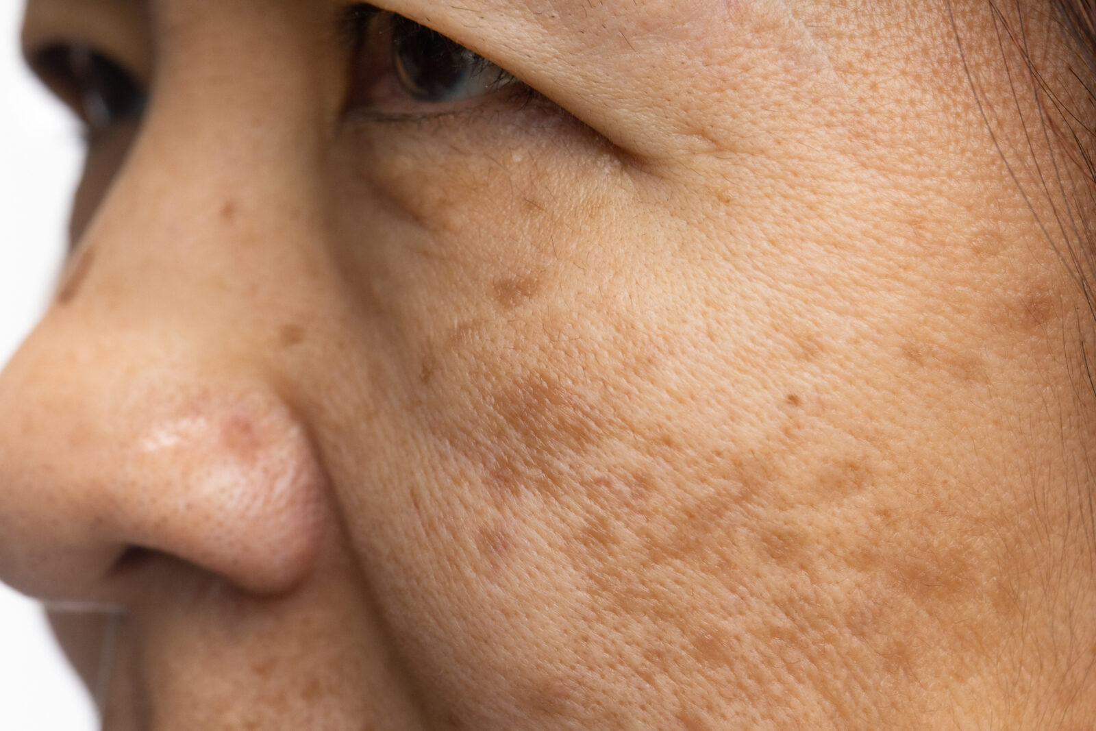 Laser Treatment Insights for Melasma: What You Need to Know