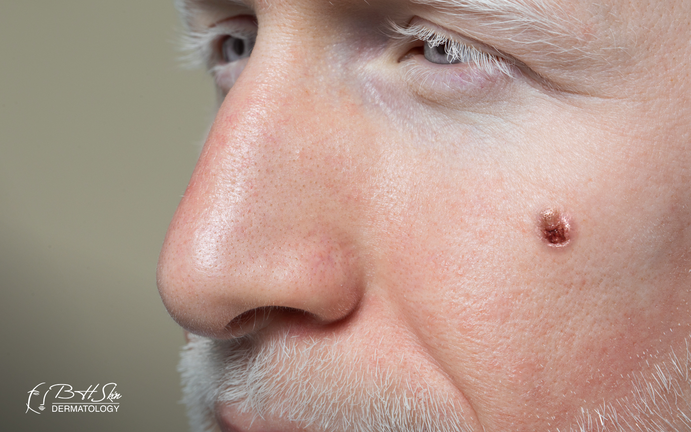 Basal Cell Carcinoma Updates: Latest Recommendations for Managing the ...
